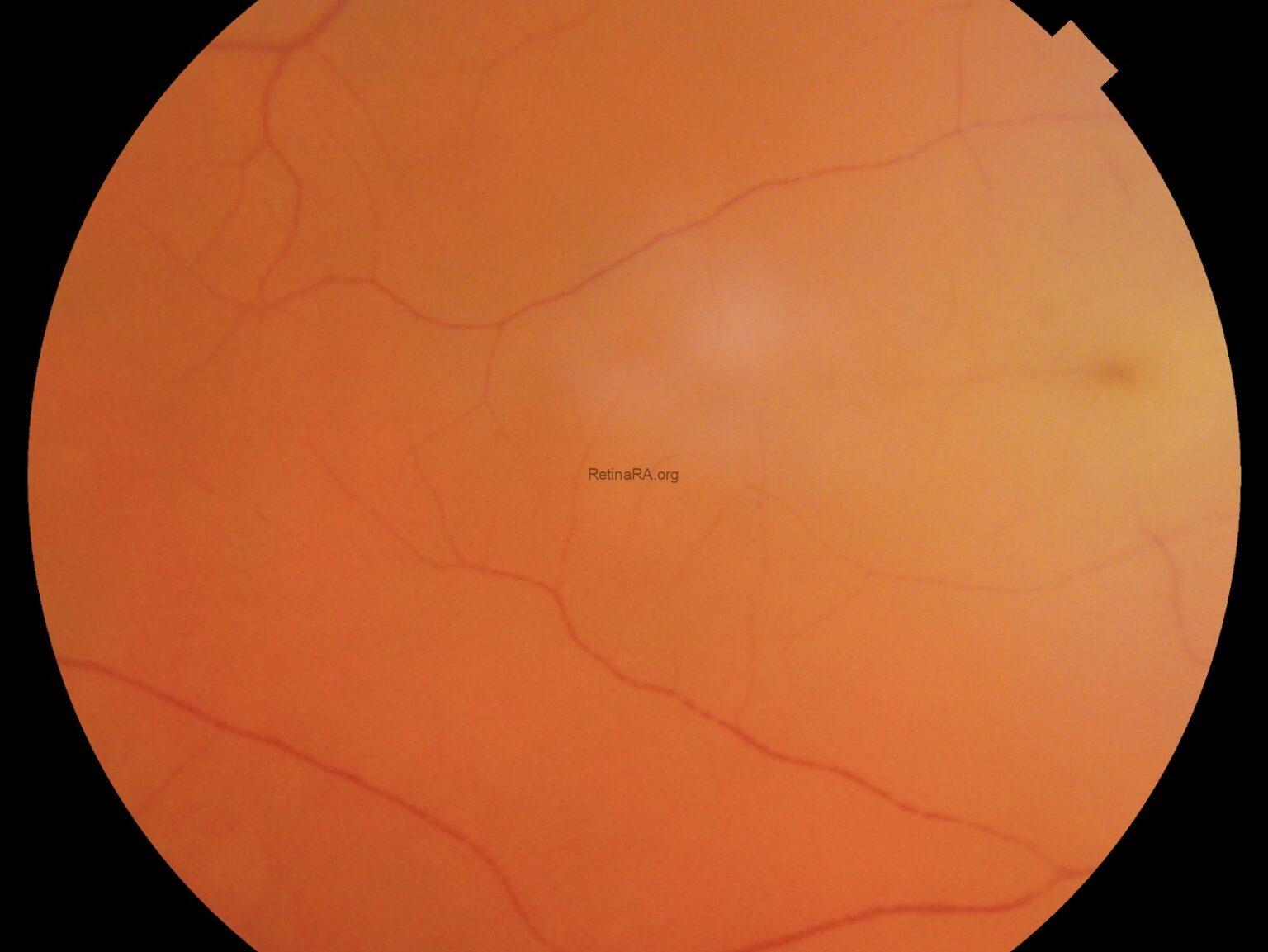 Central Retinal Artery Occlusion (CRAO) - RetinaRA