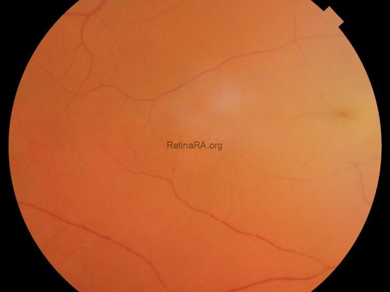 Central Retinal Artery Occlusion (CRAO) - RetinaRA