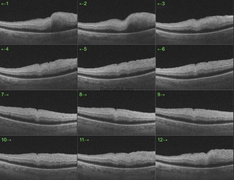 Central Retinal Artery Occlusion (CRAO) - RetinaRA