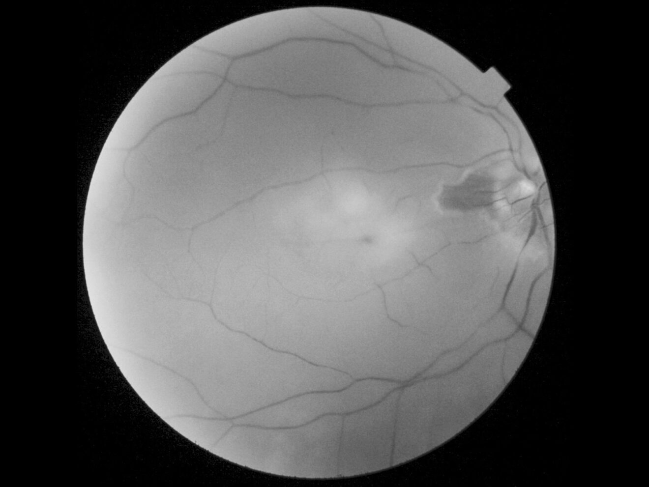Central Retinal Artery Occlusion (CRAO) - RetinaRA