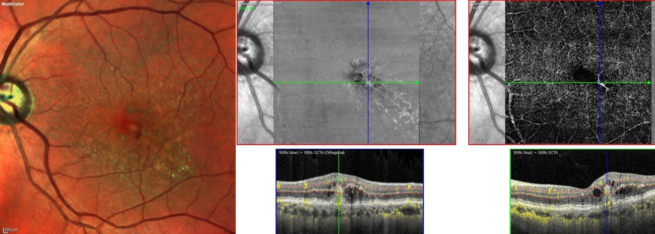 Retinal Angiomatous Proliferation (RAP) - RetinaRA
