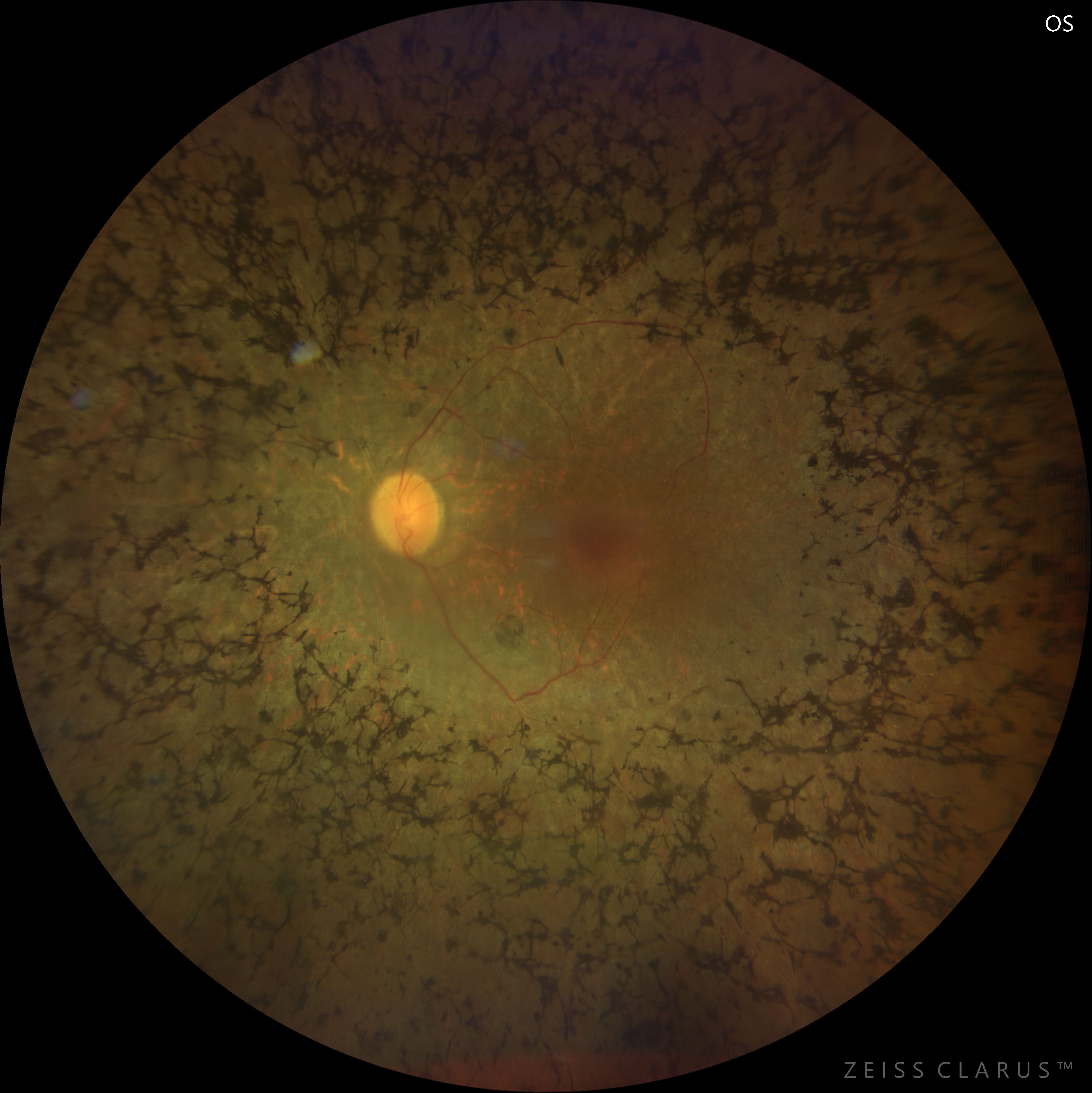 Retinitis Pigmentosa - RetinaRA